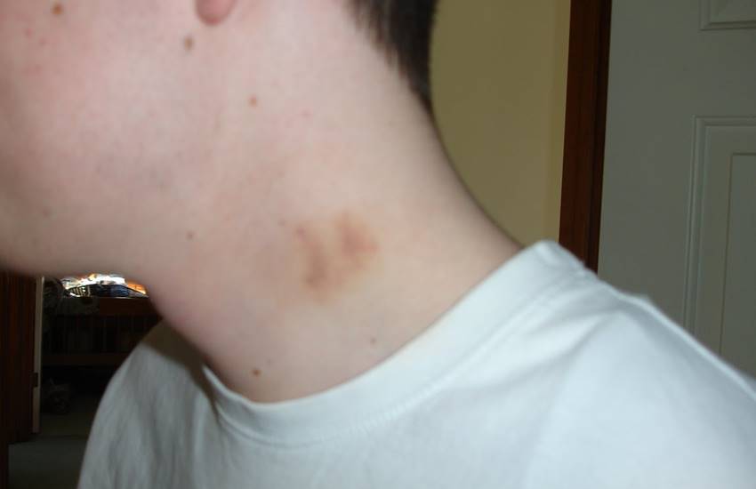 17 साल के लड़के की गई जान, लव बाइट से ब्लड क्लॉट बनने की आशंका | Jansatta