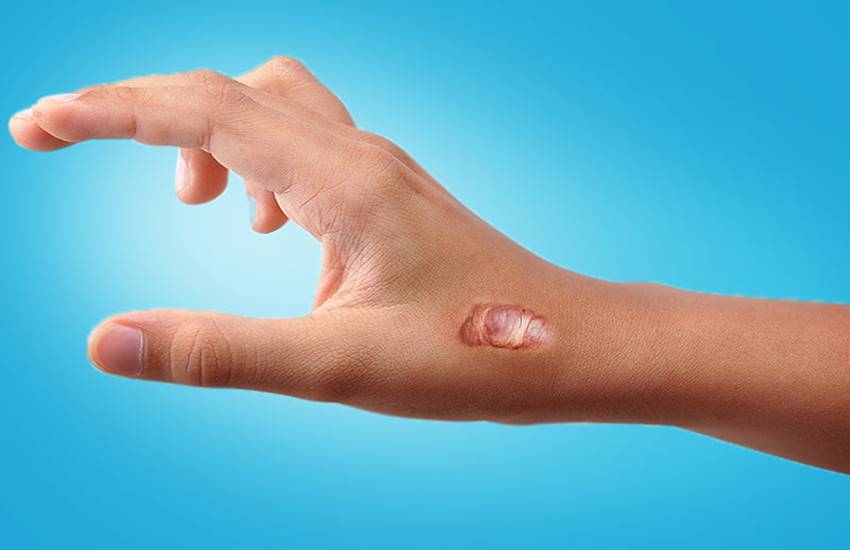 केलोइड की समस्या कर सकती है आपकी त्वचा को खराब, इन घरेलू उपचारों से पा ...