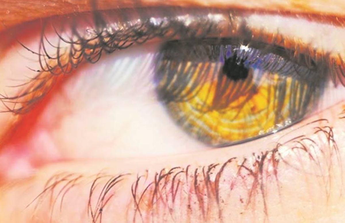 मोतियाबिंद होने के क्या कारण हैं? जानें कुछ घरेलू उपाय जो परेशानी कर ...