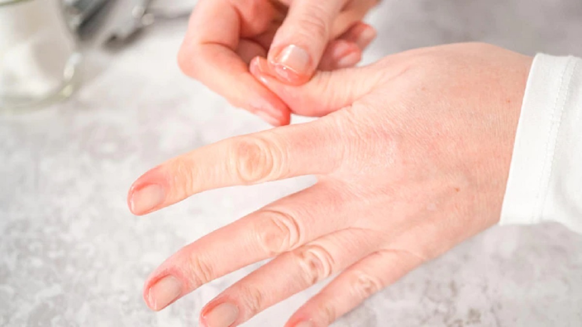 zinc deficiency can cause of white spots on your nails, know the zinc ...