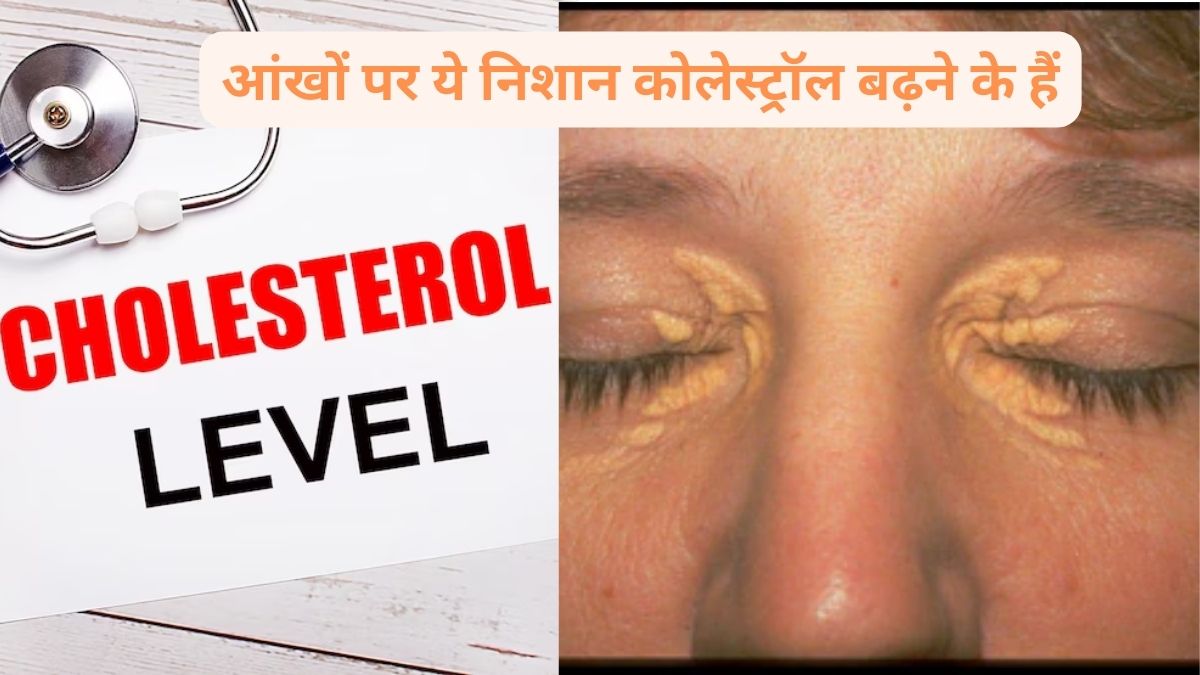 Signs of high cholesterol on the skin,know from expert how to recognize ...