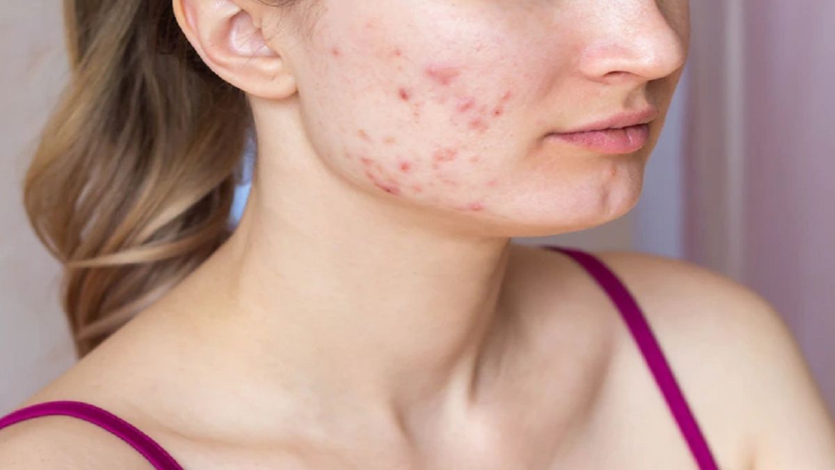 If you are troubled by acne on your face, then apply this best oil ...