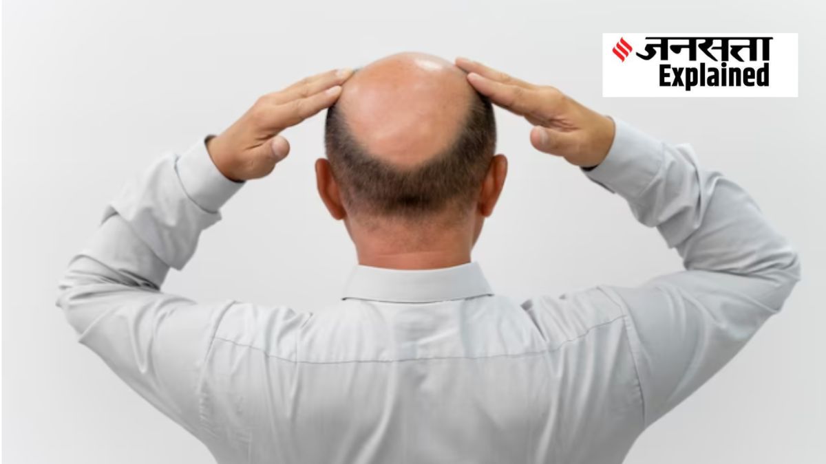 Male Pattern Baldness Androgenic Alopecia hair loss causes reason ...