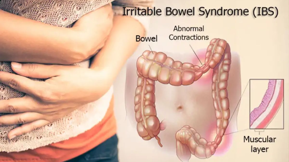 Irritable Bowel Syndrome (IBS) sign and symptoms, What is the main cause of irritable bowel ...