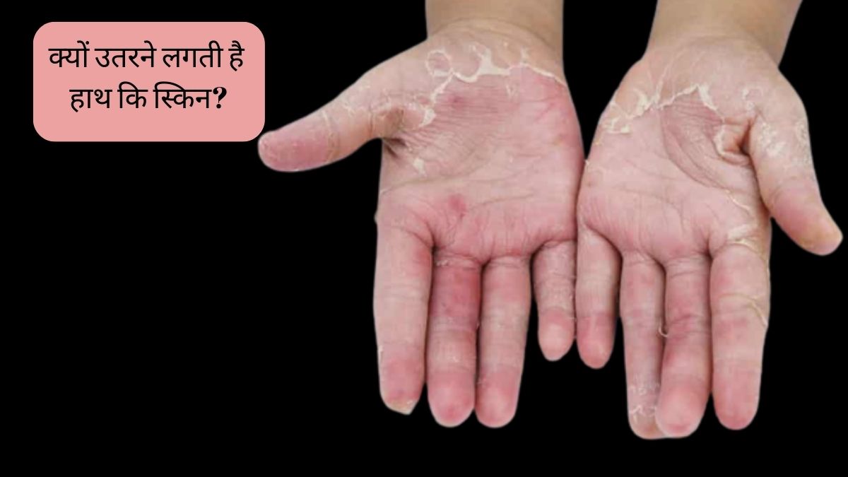 Hand Skin Peeling Cause Treatment Know How to get rid of it Naturally ...