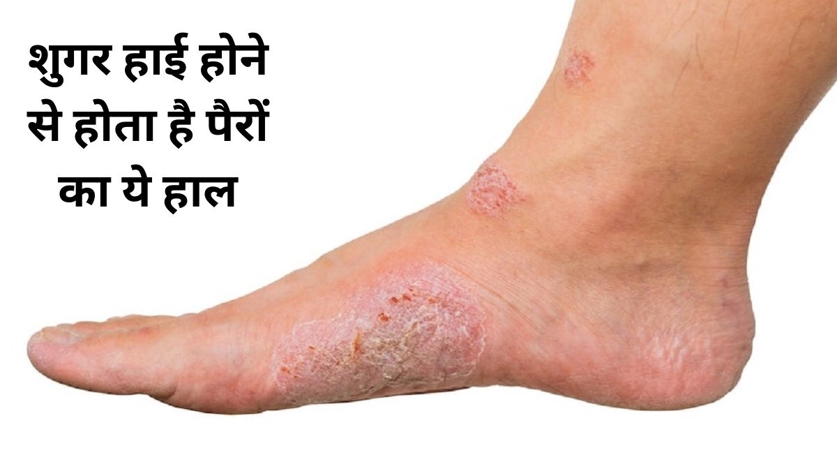 5 warning signs of diabetes in legs-डायबिटीज का शिकार होने पर पैरों में ...