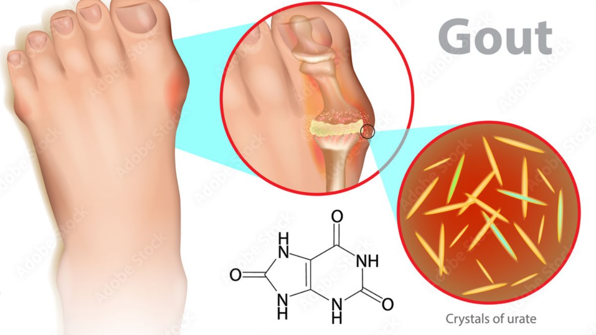 Why is the level of Uric Acid always high? Hyperuricemia Symptoms and ...
