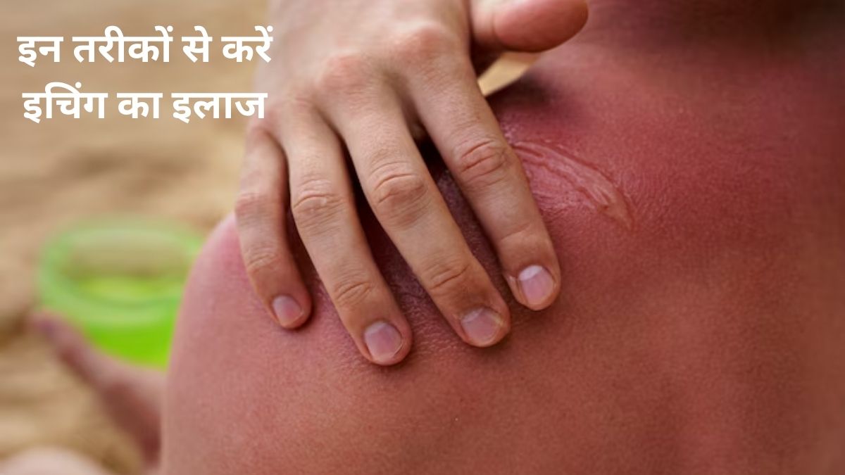 गर्मी में कमर पर घमौरियों से खुजाते-खुजाते हो गया है बुरा हाल, 4 धांसू ...