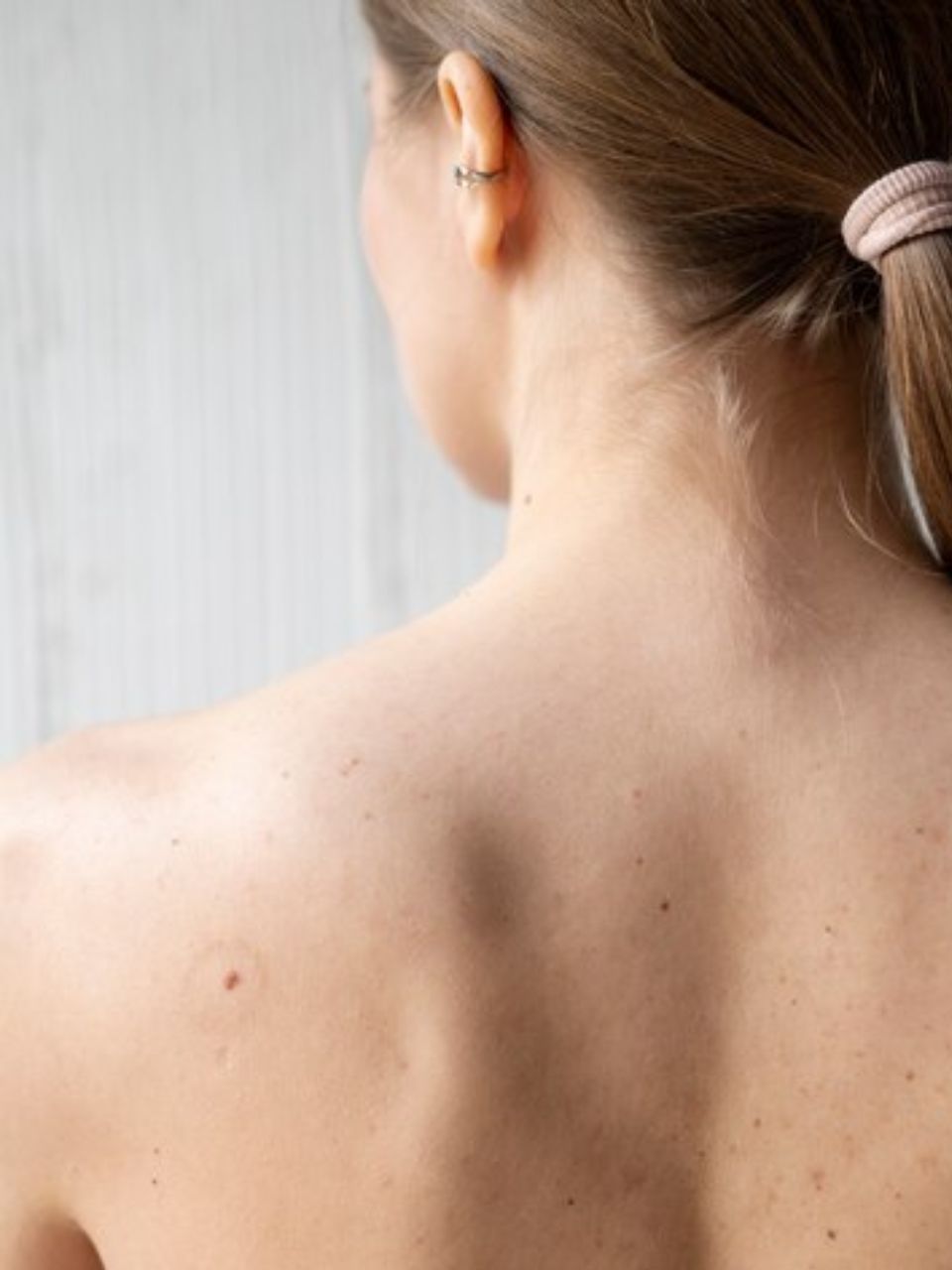 4 Easy Tips to get rid of prickly heat rash