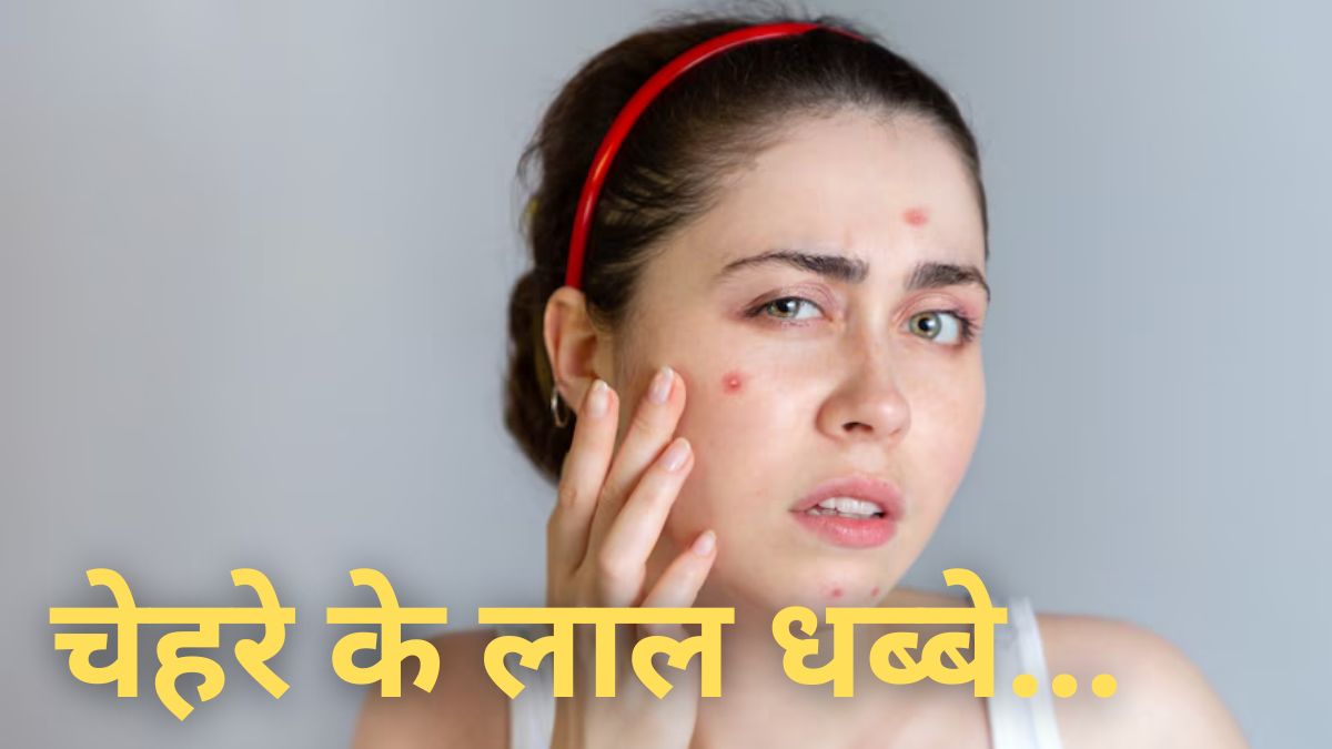 Red Spots On The Skin:; चेहरे पर आए लाल स्किन को कैसे करें ठीक | Jansatta