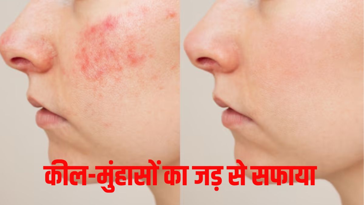 How to get rid of pimples naturally , home remedies for pimples and ...