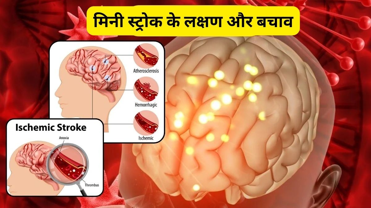Mini Stroke: जब हो जाता है दिमाग में खून जाना बंद? इन 5 संकेत से पता ...